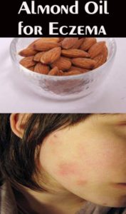 How to Use Almond Oil for Eczema - 10 DIY Methods - Skin Disease Remedies