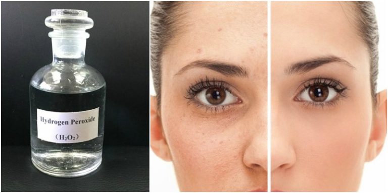 7 Recipes using Hydrogen Peroxide for Skin-Whitening - Skin Disease ...