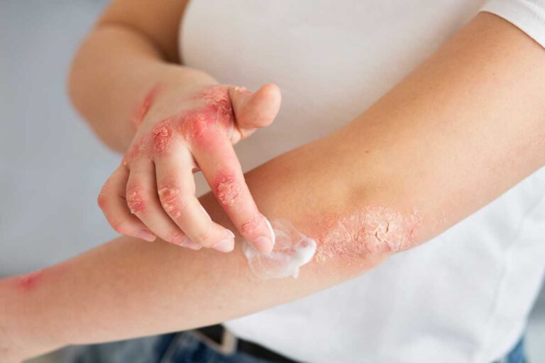 Chemical Burn: Common Causes, Symptoms, and Treatment - Skin Disease ...