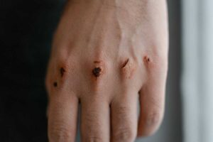 Home Remedies to Stop Bleeding: Natural Solutions for Cuts and Wounds ...