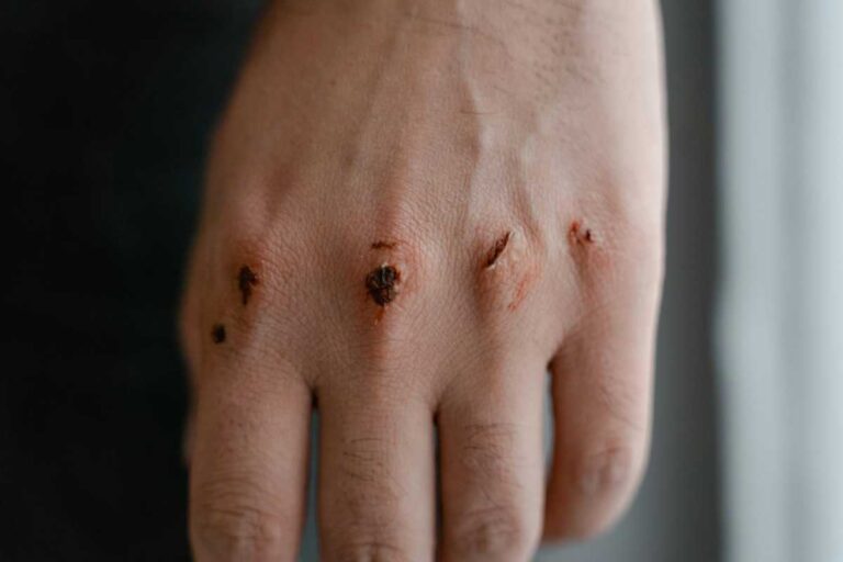 Home Remedies to Stop Bleeding: Natural Solutions for Cuts and Wounds ...